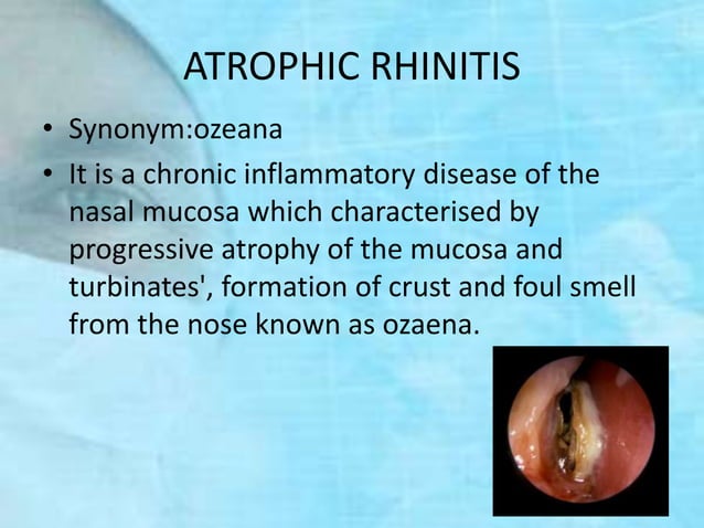 Rhinitis | PPTX | Ear, Nose and Throat Conditions | Diseases and Conditions