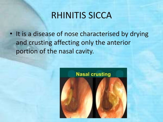 Rhinitis | PPTX | Ear, Nose and Throat Conditions | Diseases and Conditions