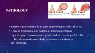 acute and chronic rhinitis by dr supriya | PPTX