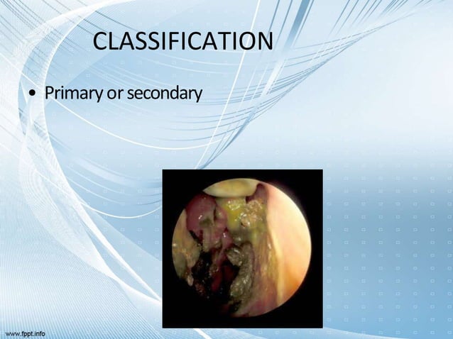 Rhinitis types | PPTX