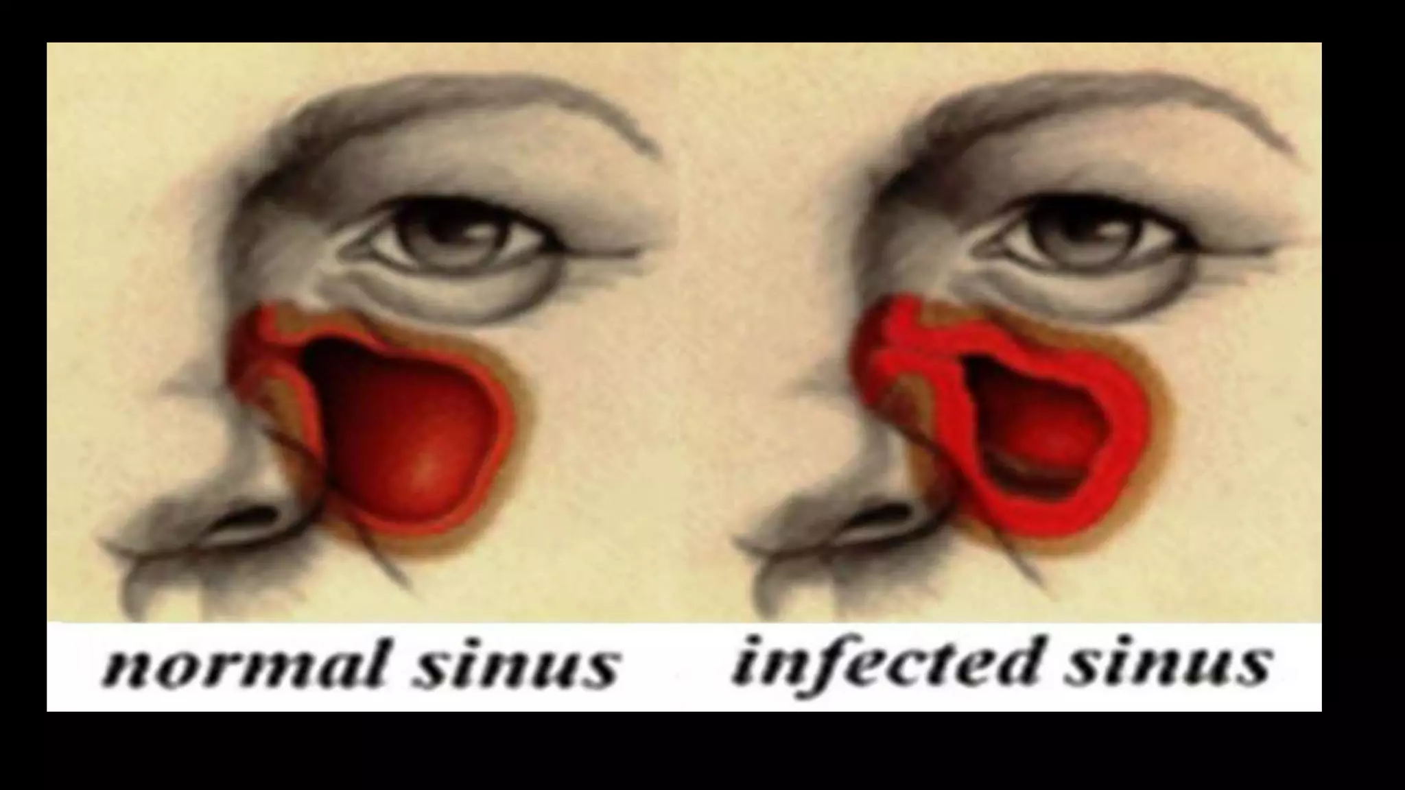 Rhinosinusitis- Definition, Clinical features, Diagnosis.pptx