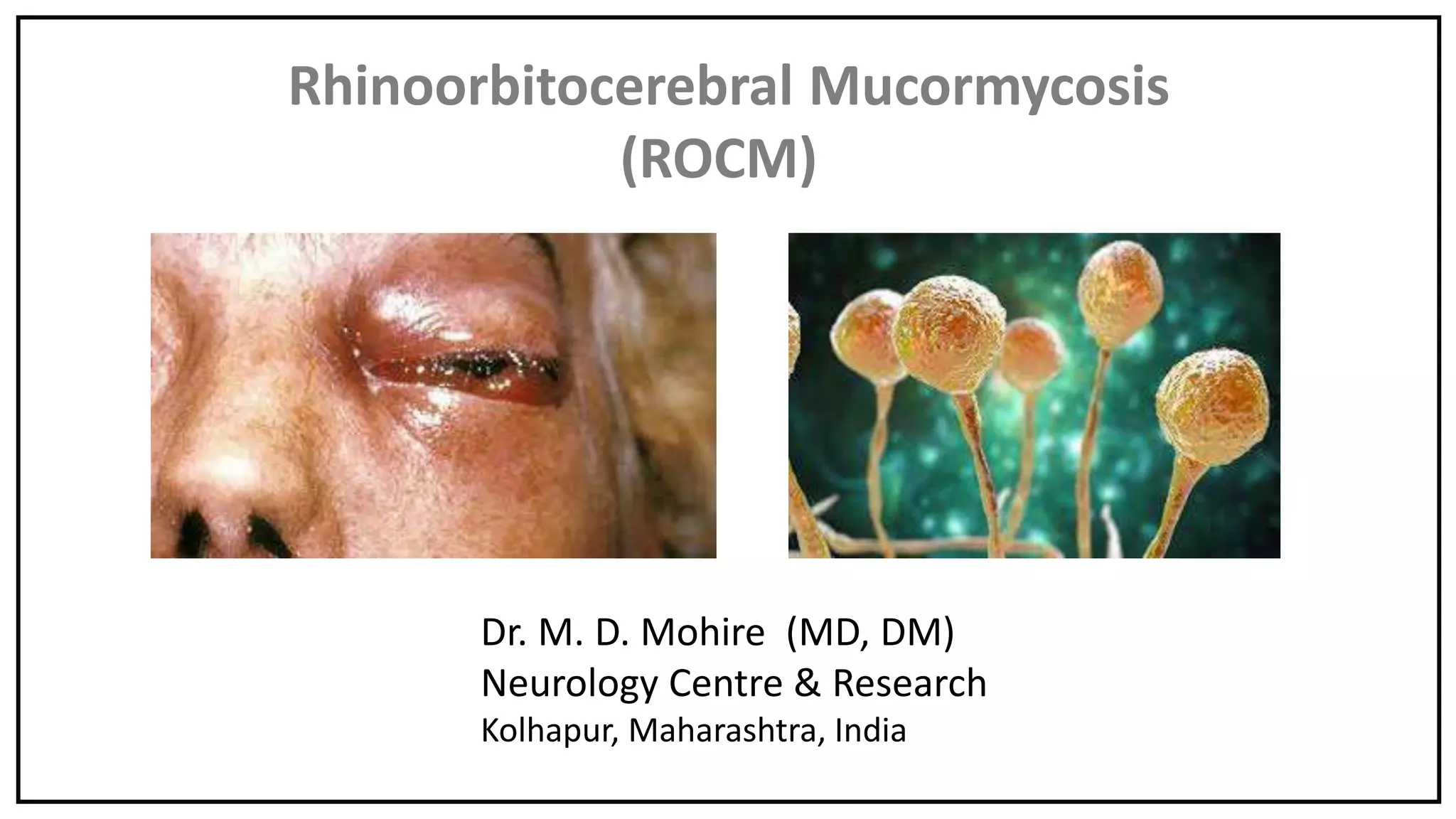 Rhinocerebral mucormycosis | PPTX