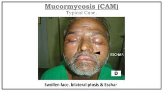 Rhinocerebral mucormycosis | PPTX