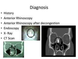 Rhinolith | PPT