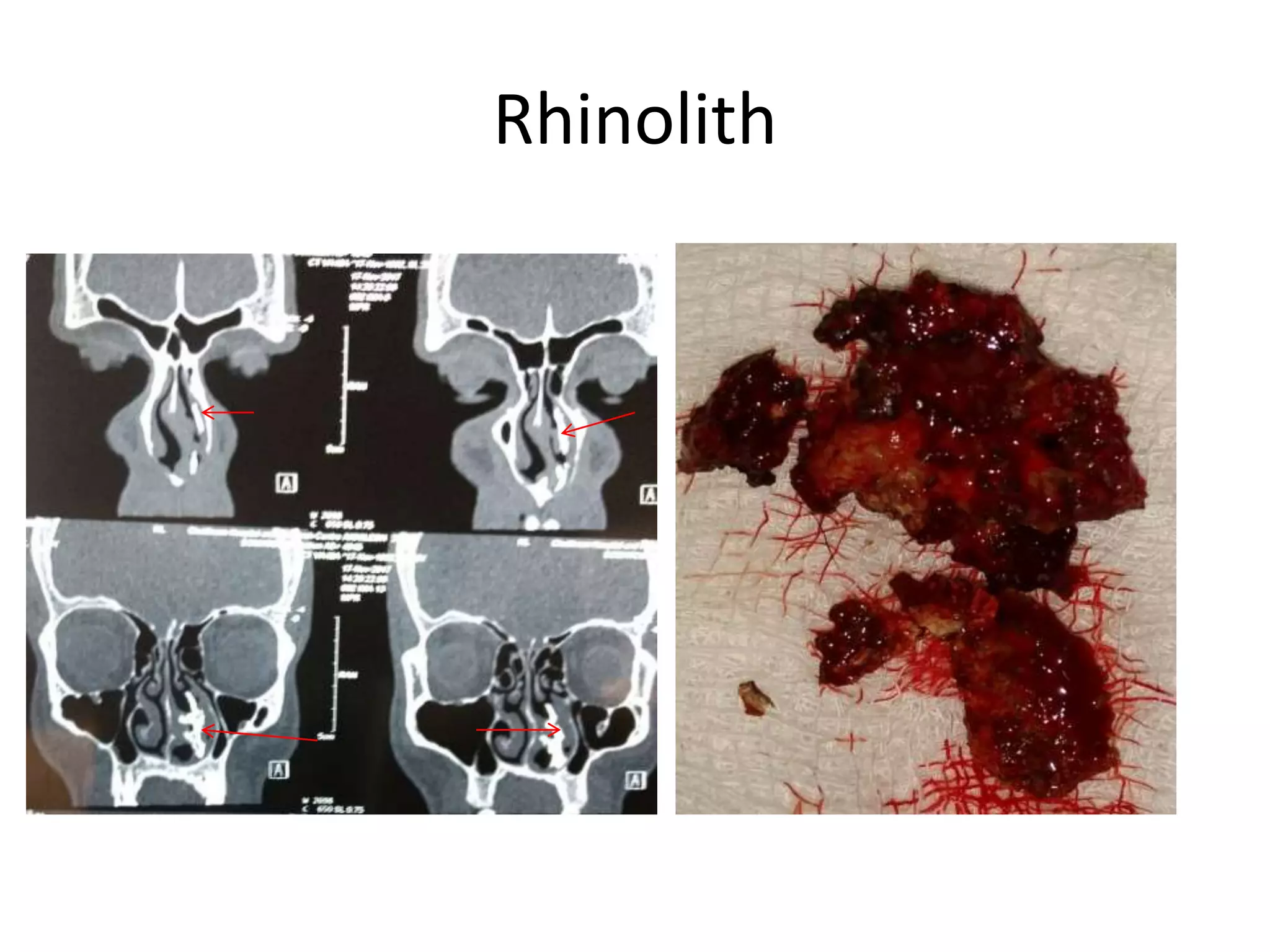 Rhinolith : Stone formation Nose | PPTX