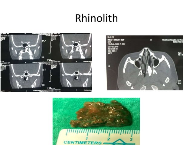 Rhinolith : Stone formation Nose | PPTX