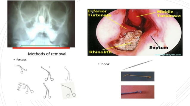 Rhinolith | PPTX | Ear, Nose and Throat Conditions | Diseases and Conditions