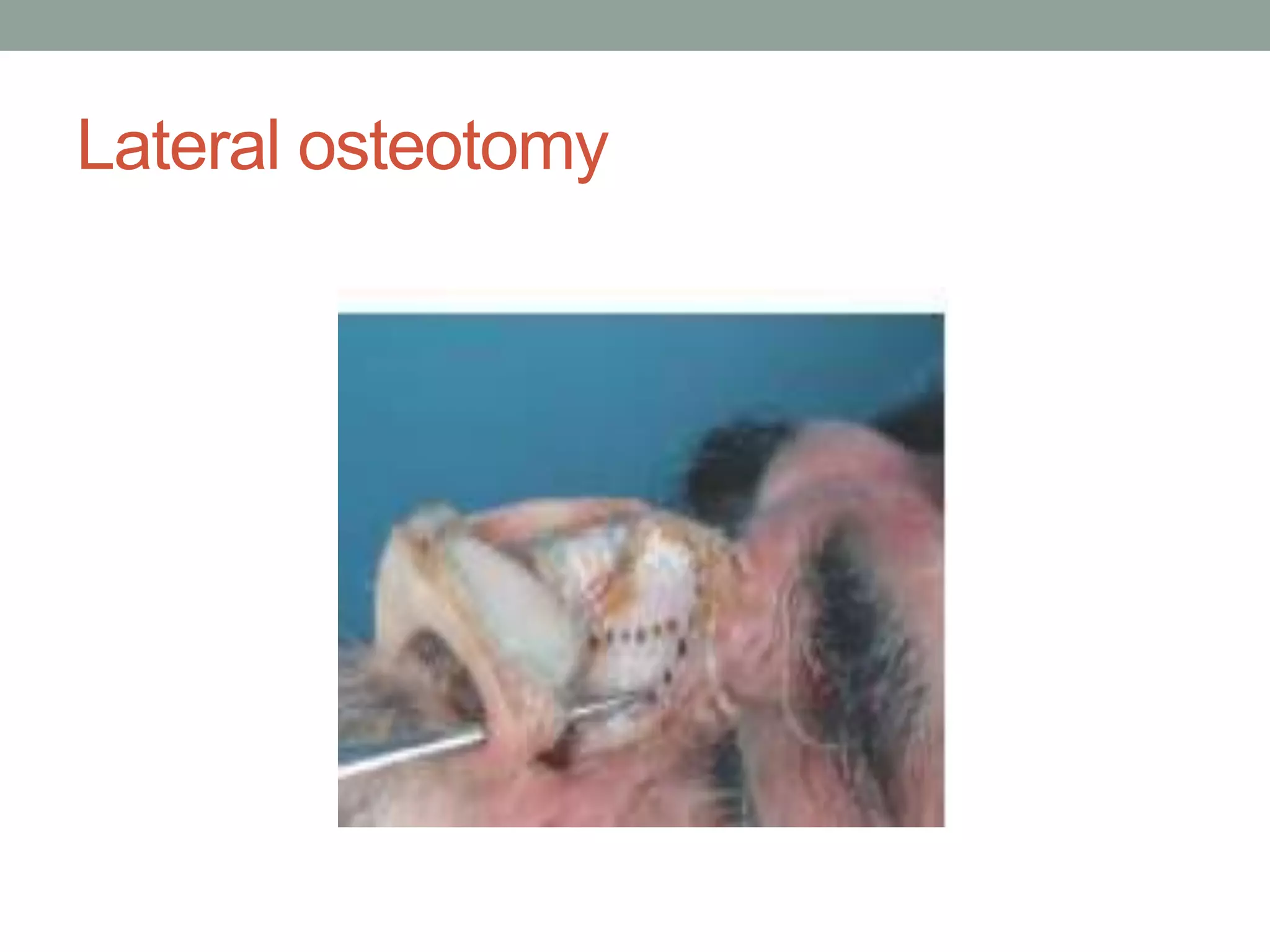Rhinoplasty | PPTX