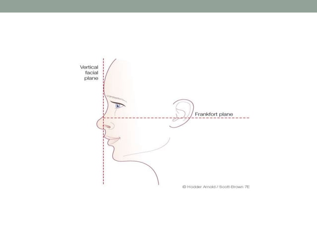 Rhinoplasty | PPTX