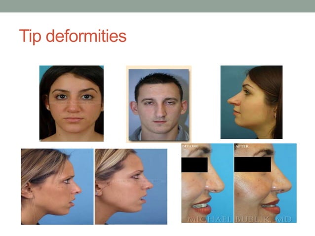Rhinoplasty | PPTX