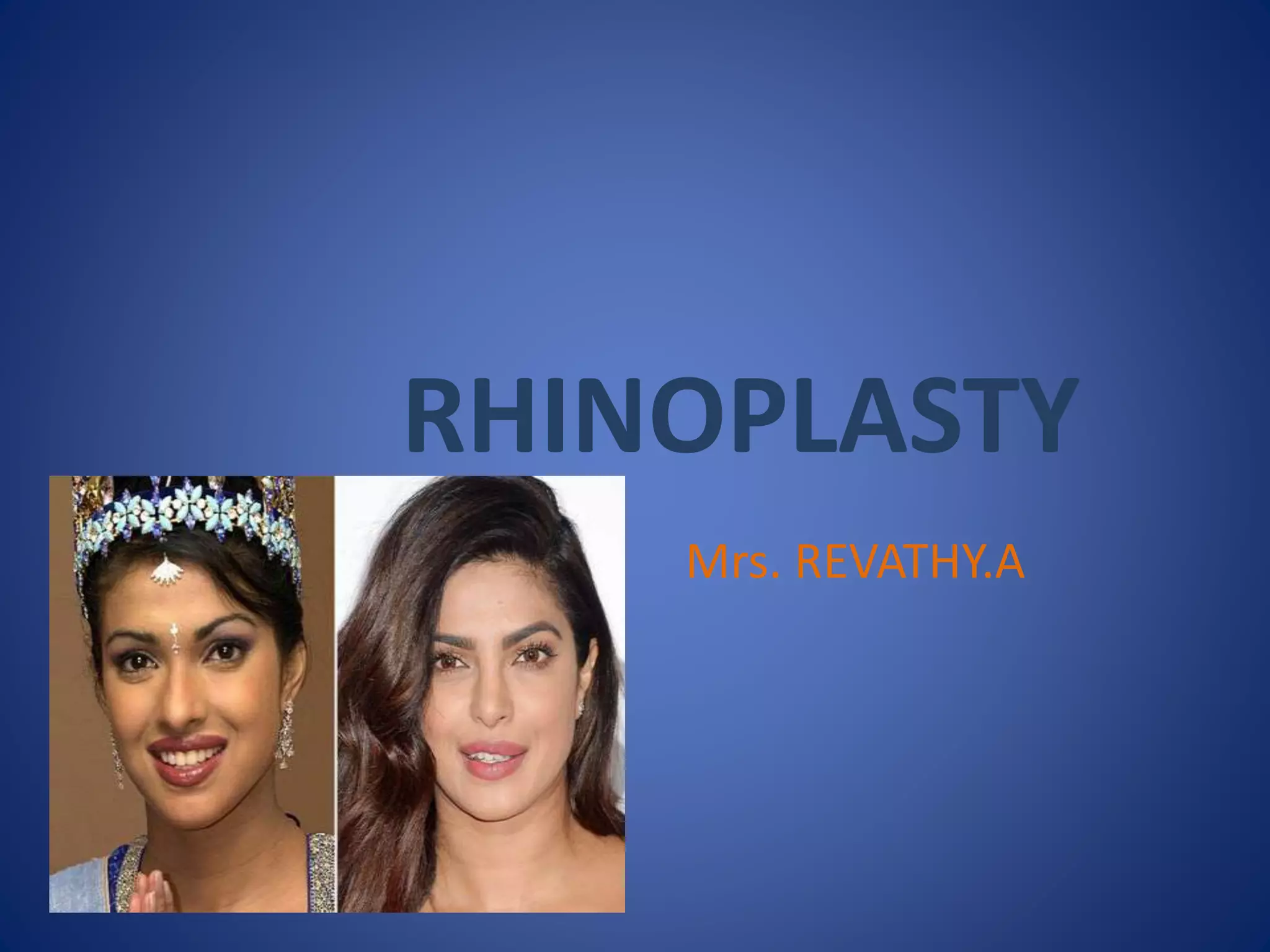 Rhinoplasty | PPTX