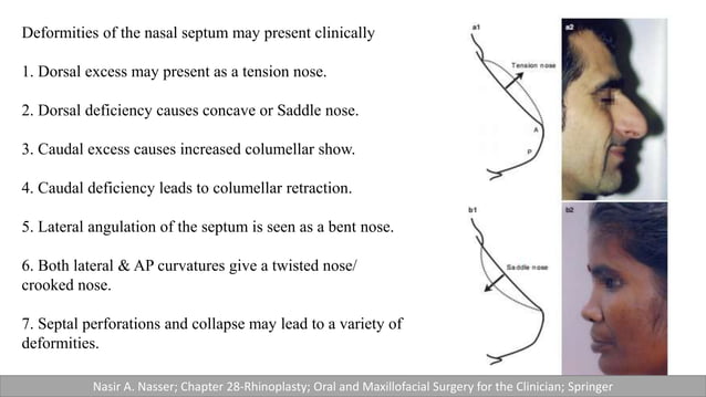 Rhinoplasty.pptx