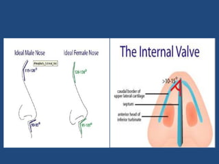 RHINOPLASTY ,Types of incision & Osteotomies.pptx