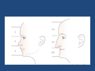 RHINOPLASTY ,Types of incision & Osteotomies.pptx