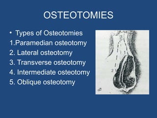 RHINOPLASTY ,Types of incision & Osteotomies.pptx