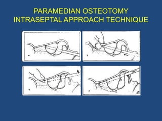 RHINOPLASTY ,Types of incision & Osteotomies.pptx