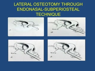 RHINOPLASTY ,Types of incision & Osteotomies.pptx