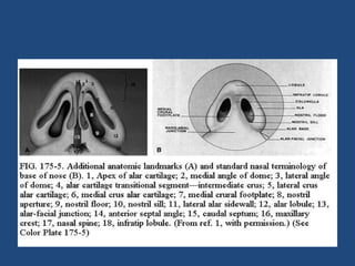 RHINOPLASTY ,Types of incision & Osteotomies.pptx