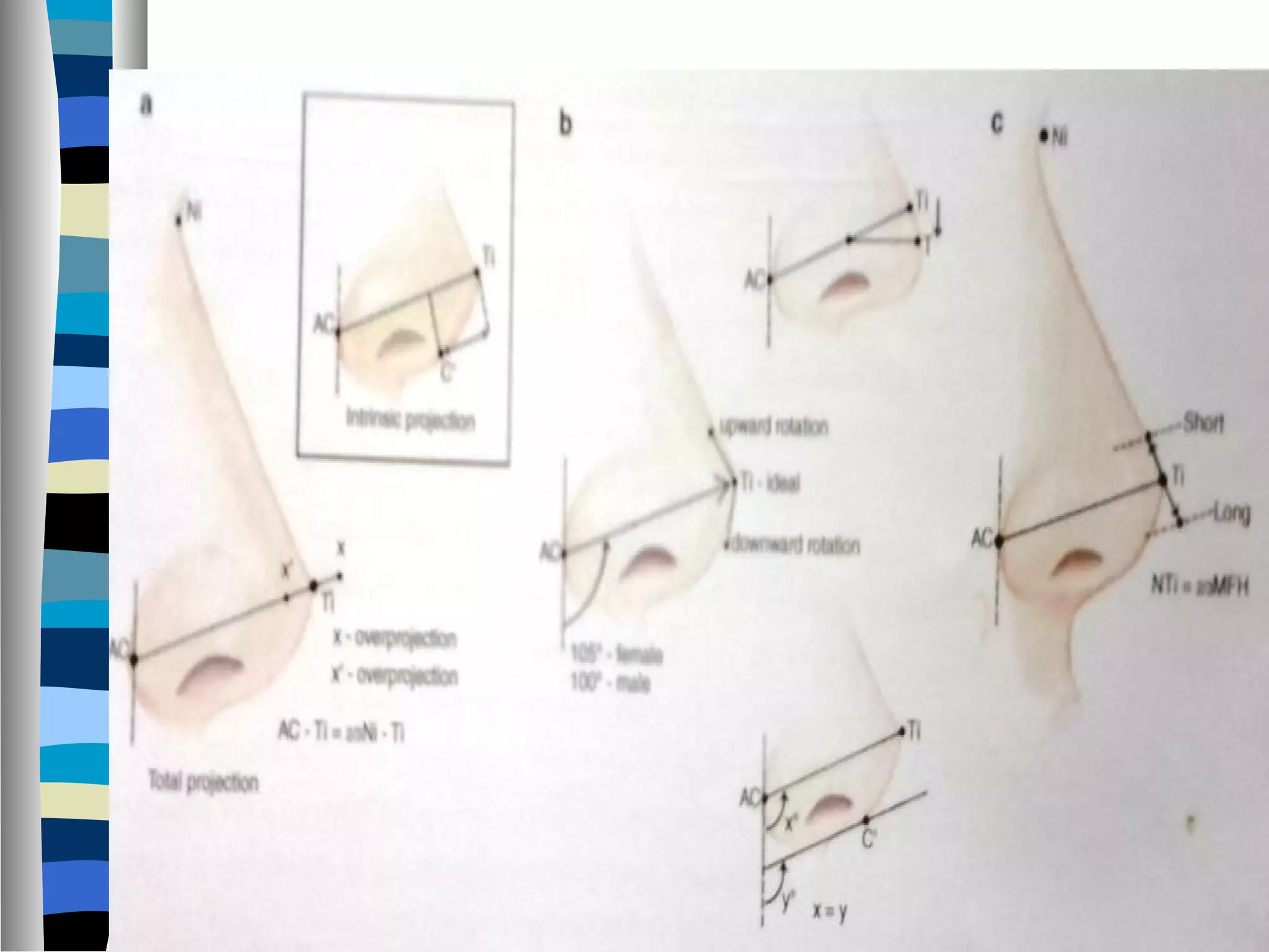 Rhinoplasty approaches ,anatomy,techniques | PPT