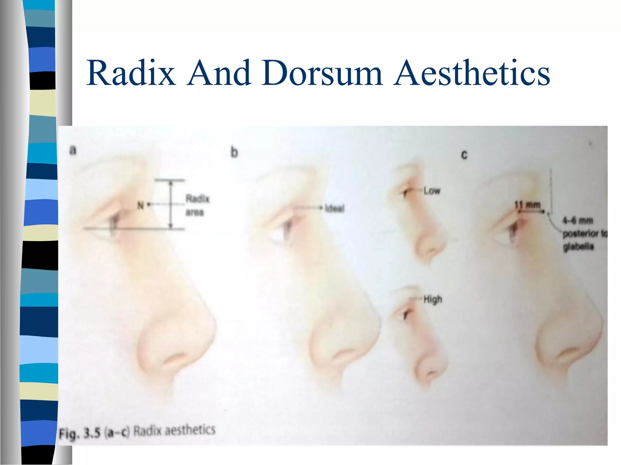 Rhinoplasty approaches ,anatomy,techniques | PPT