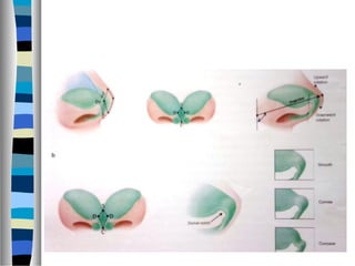 Rhinoplasty approaches ,anatomy,techniques | PPT