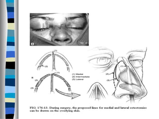 Rhinoplasty approaches ,anatomy,techniques | PPT