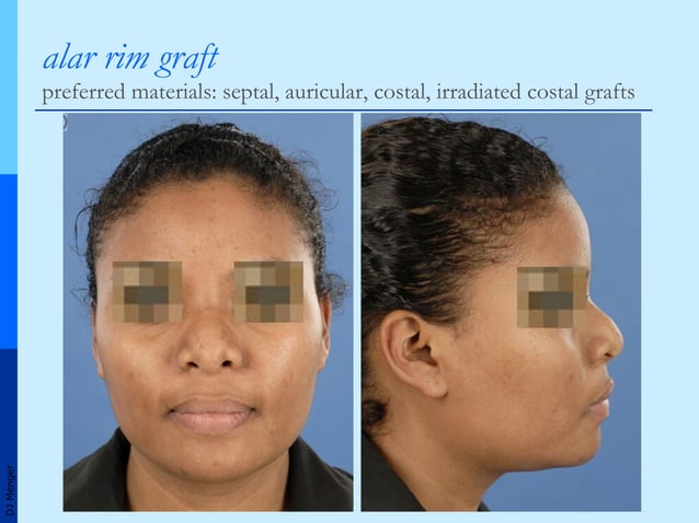 Grafts in Nasal Surgery v1 | PPT