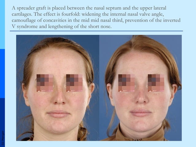 Grafts in Nasal Surgery v1 | PPT