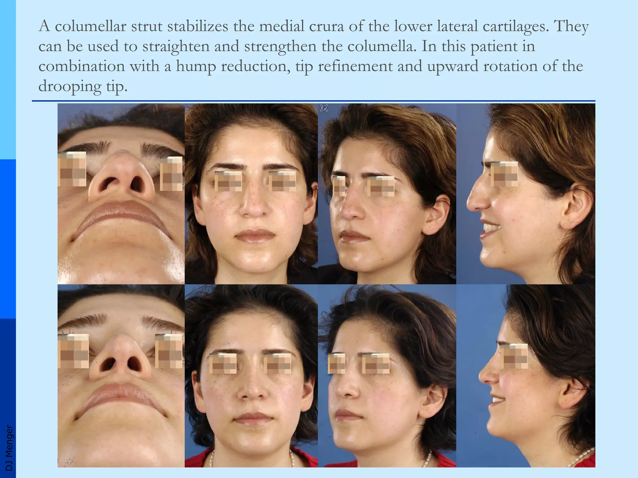 Grafts in Nasal Surgery v2 | PPT