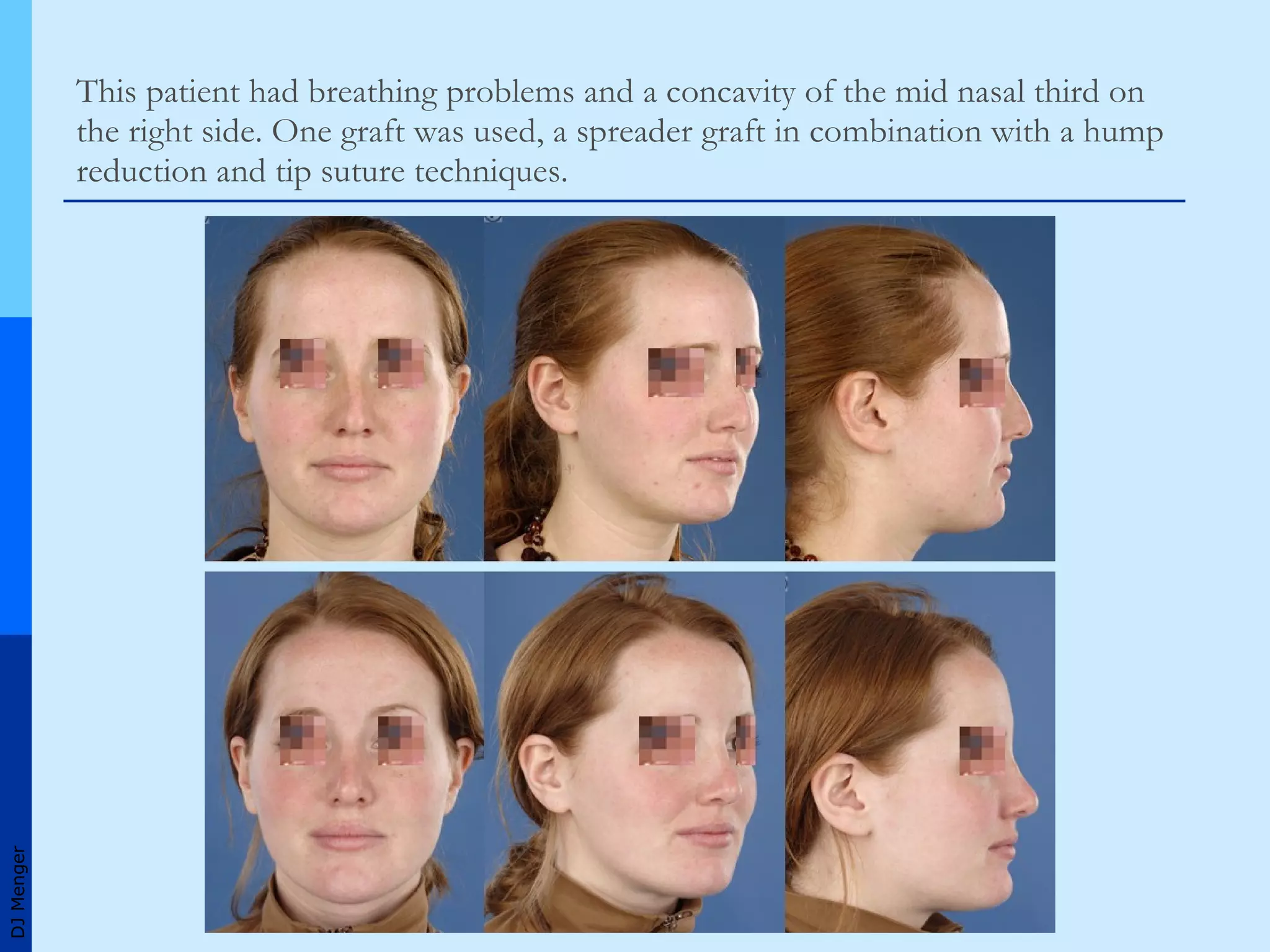 Grafts in Nasal Surgery v2 | PPT