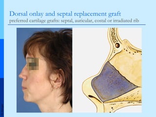 Grafts in Nasal Surgery v2 | PPT