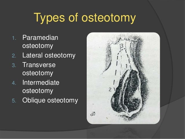Rhinoplasty raju ppt full