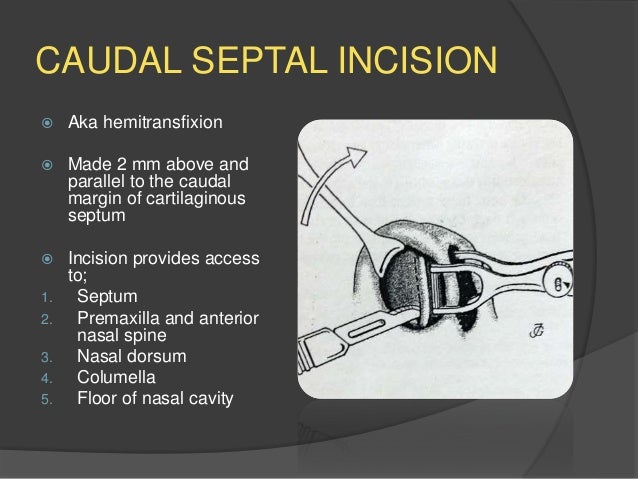 Rhinoplasty raju ppt full