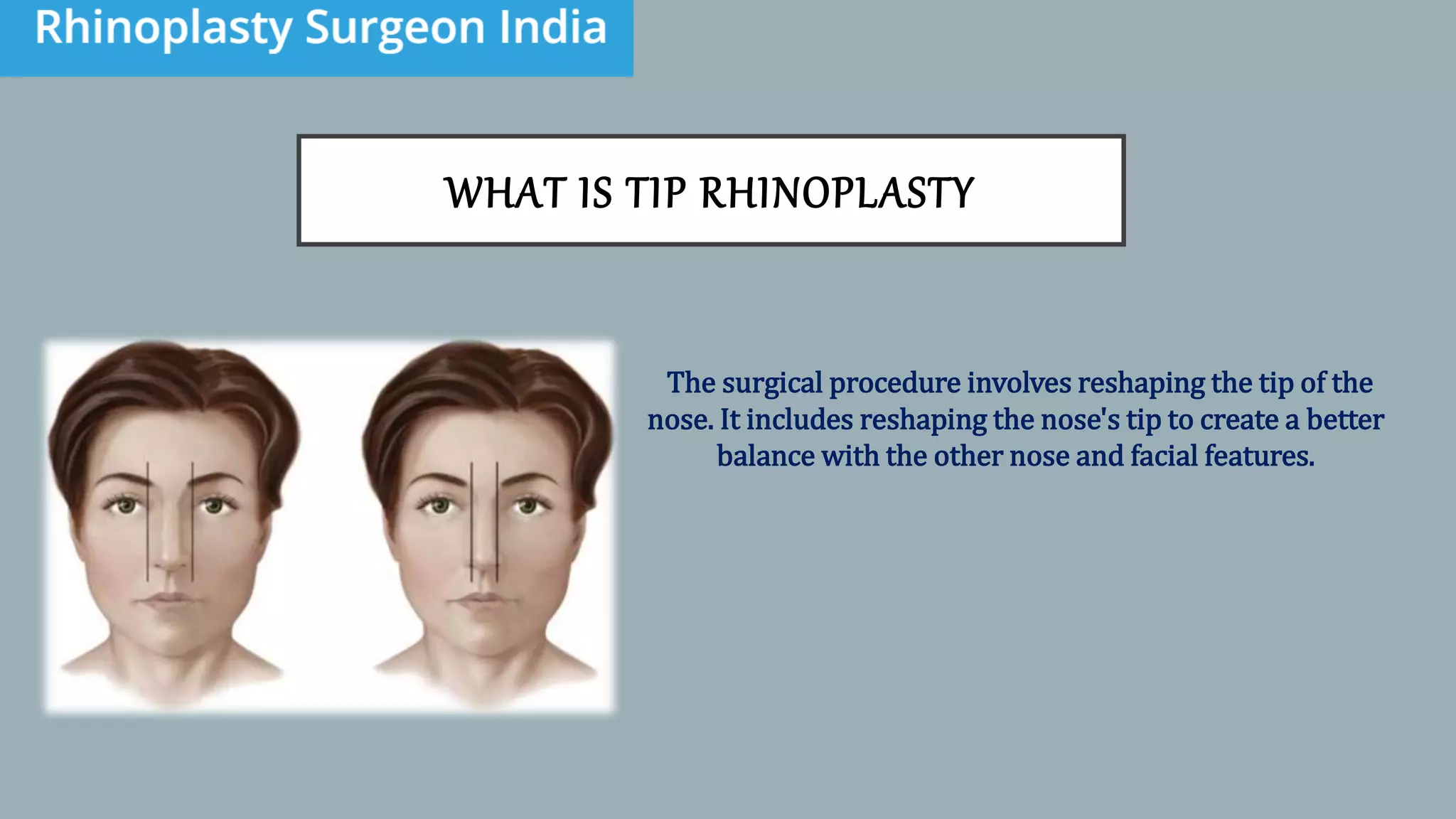 What is Tip Rhinoplasty - Tip Rhinoplasty PPT | PPT
