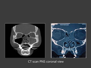 Rhinosinusitis(acute,chronic,fungal) ENT | PPTX