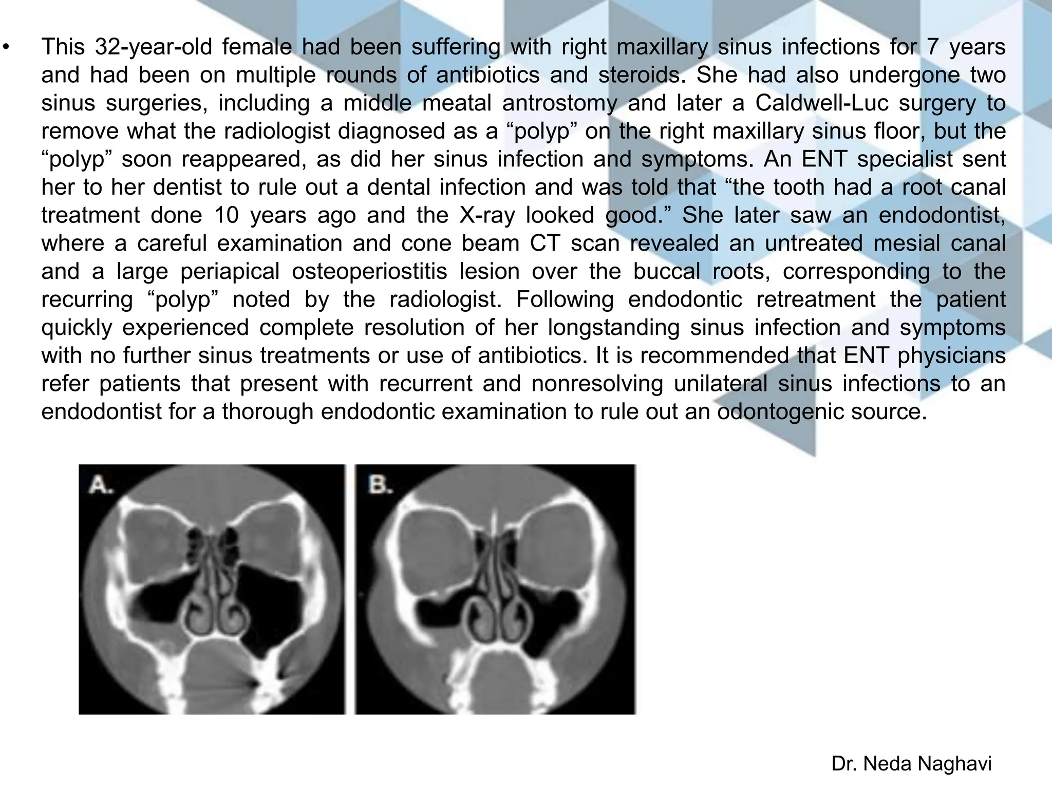 Rhinosinusitis and Endodontic Disease.ppt