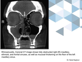 Rhinosinusitis and Endodontic Disease.ppt