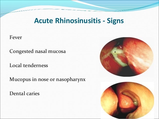 Rhinosinusitis