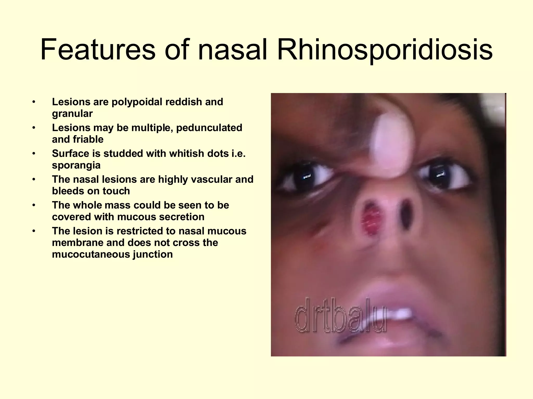 Rhinosporidiosis | PPT
