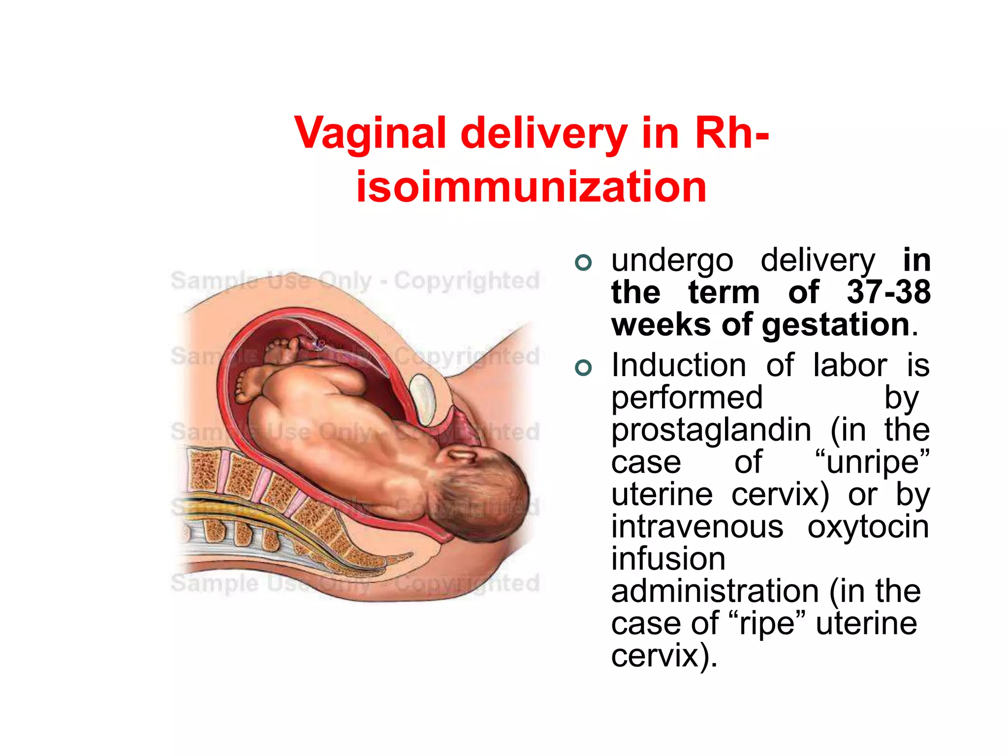 Rh isoimmunization | PPTX
