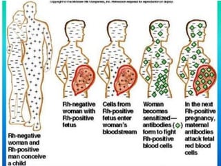 Rh isoimmunization | PPTX