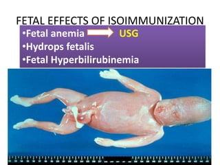 Rh isoimmunization | PPTX