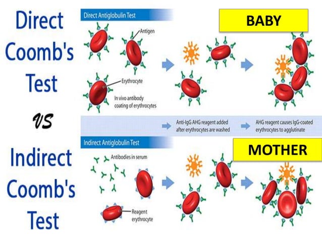 Rh isoimmunization | PPT