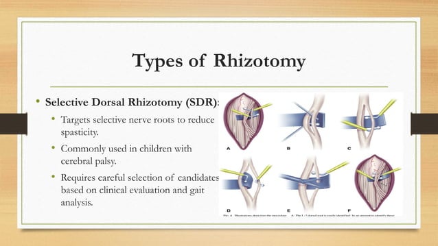 Rhizotomy:A surgical intervention for spasticity.pptx