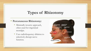 Rhizotomy:A surgical intervention for spasticity.pptx