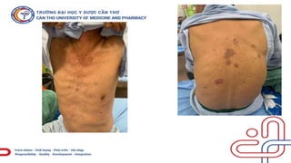 Chàm - Bệnh án (da liễu - bvdlct ctump) .pptx