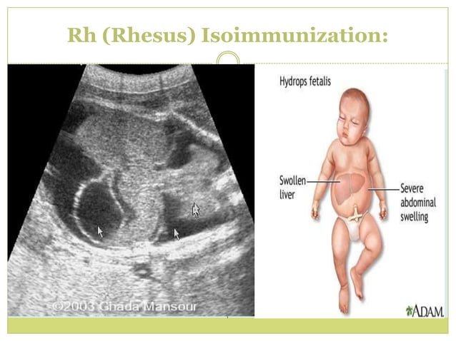 Rh Rhesus Isoimmunization | PPTX
