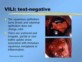 Visual inspection with Lugol’s iodine | PDF