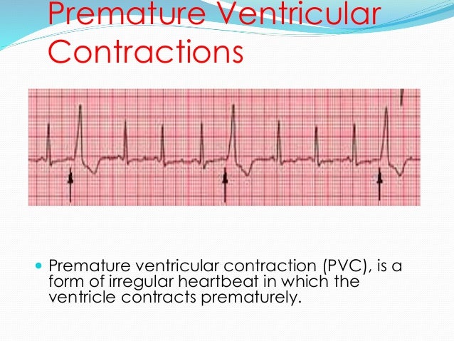 Premature Atrial Contractions Vs Premature Ventricular Contractions