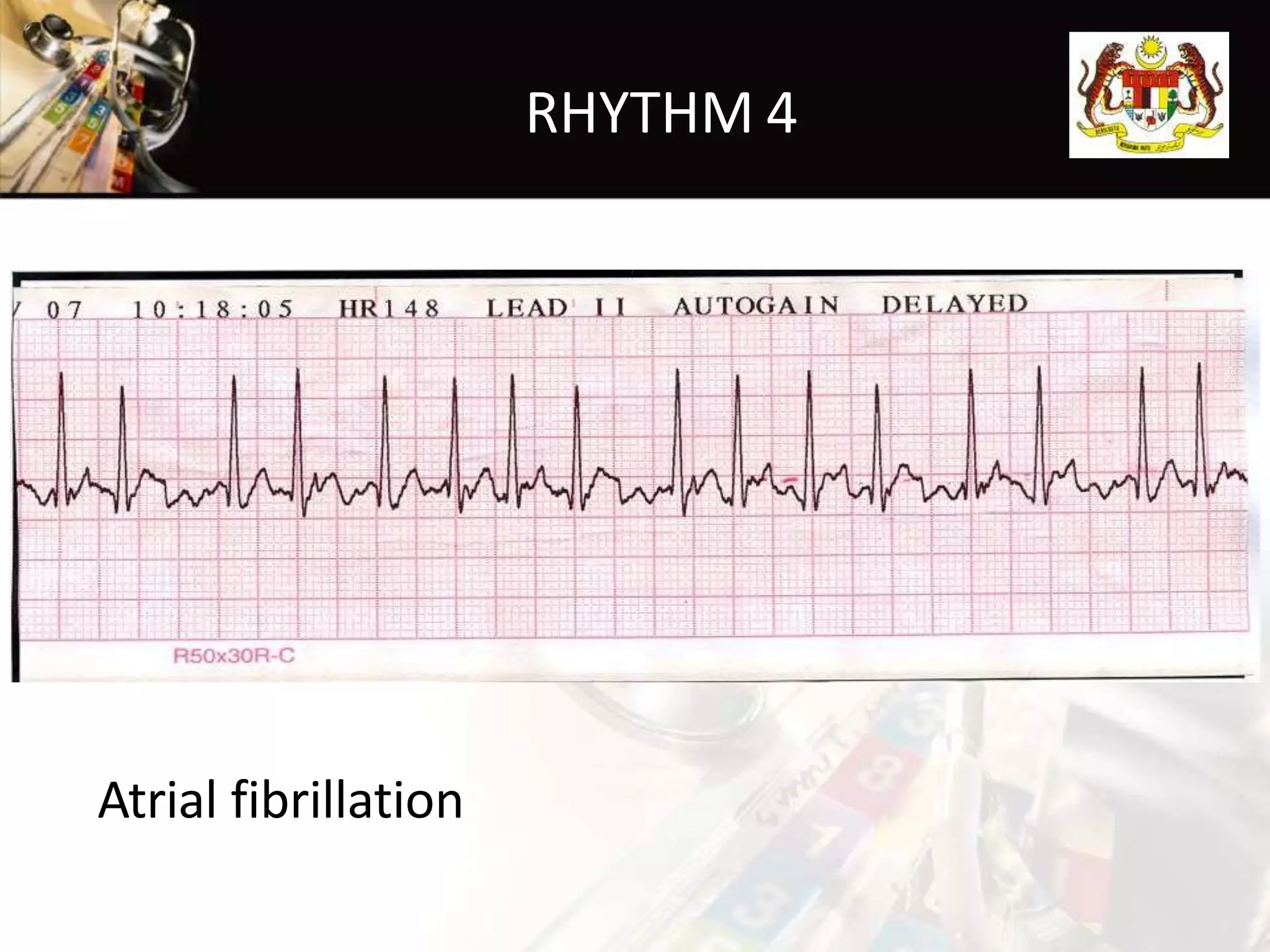 Rhythm recognition | PPTX